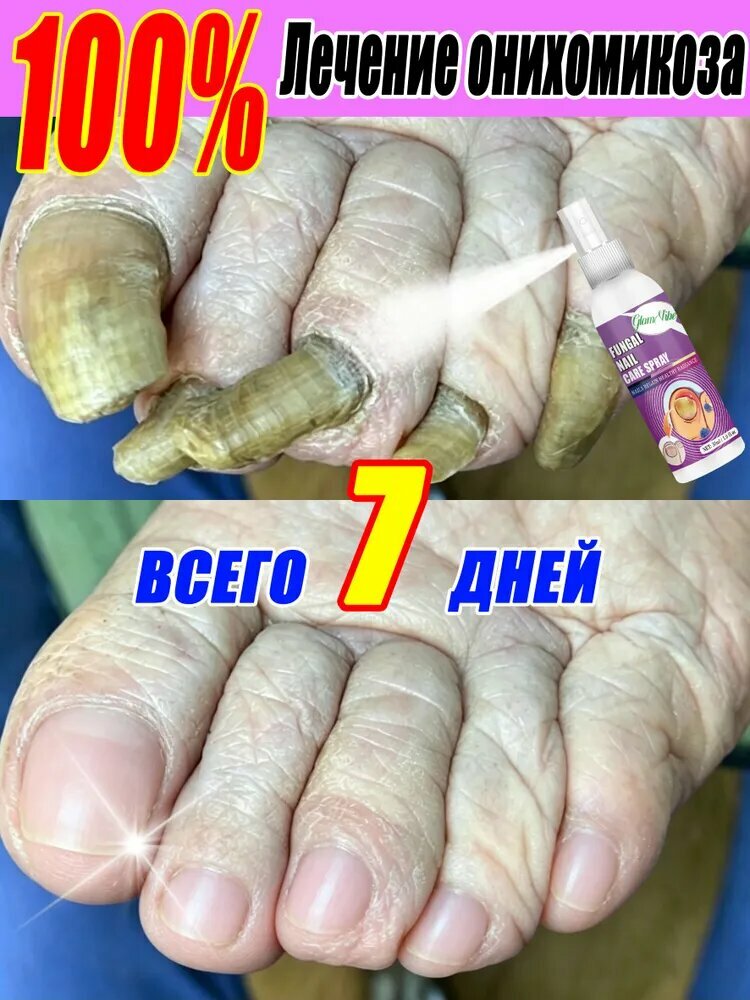 Спрей для лечения, укрепления и восстановления грибковых инфекций ногтей на ногах и ногтях на руках. Лечит онихомикоз, подавляет рост грибков и способствует здоровому росту ногтей.