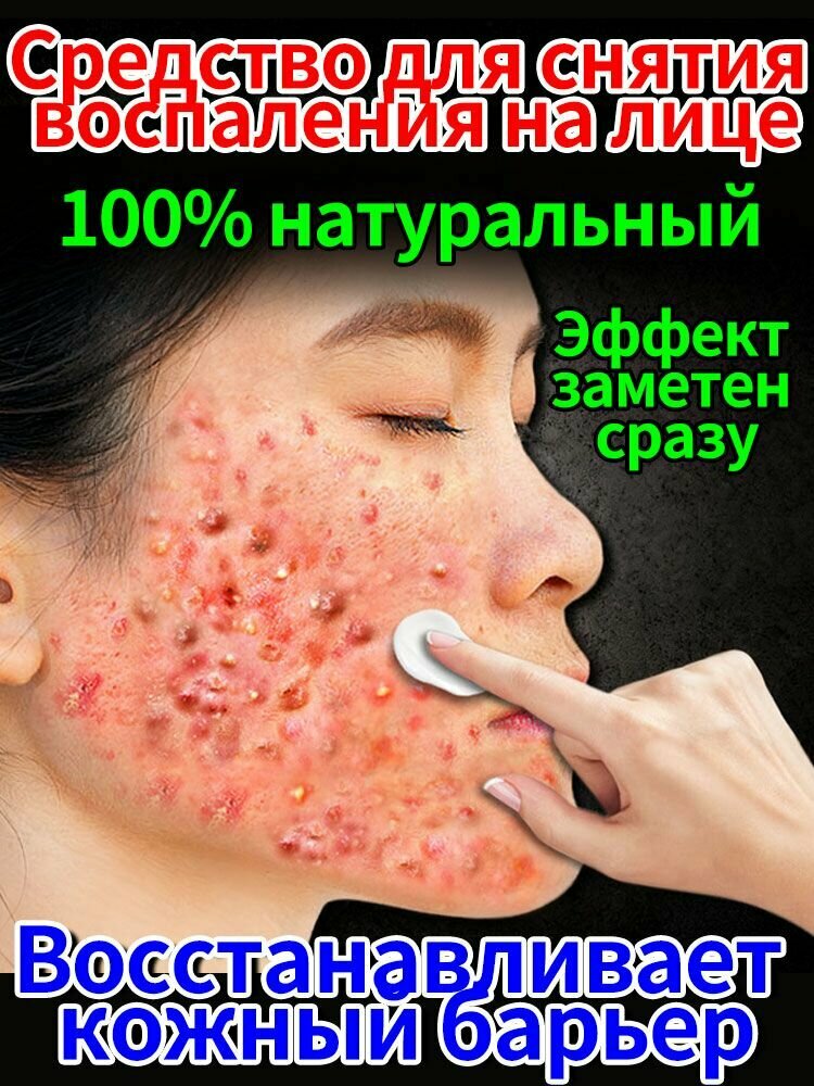 Крем от розацеа на лице купероза и покраснений 30 г, уменьшает покраснение и припухлость носа, гиперемию и жирность кожи