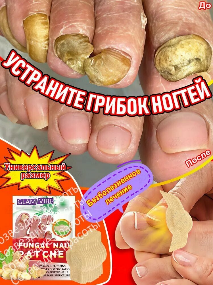 Грибковые пластыри при онихомикозе обеспечивают быстрое лечение онихомикоза на руках и ногах, ухаживают за ногтями, снимают зуд, улучшают паронихий и не вызывают раздражения.21 таблетка