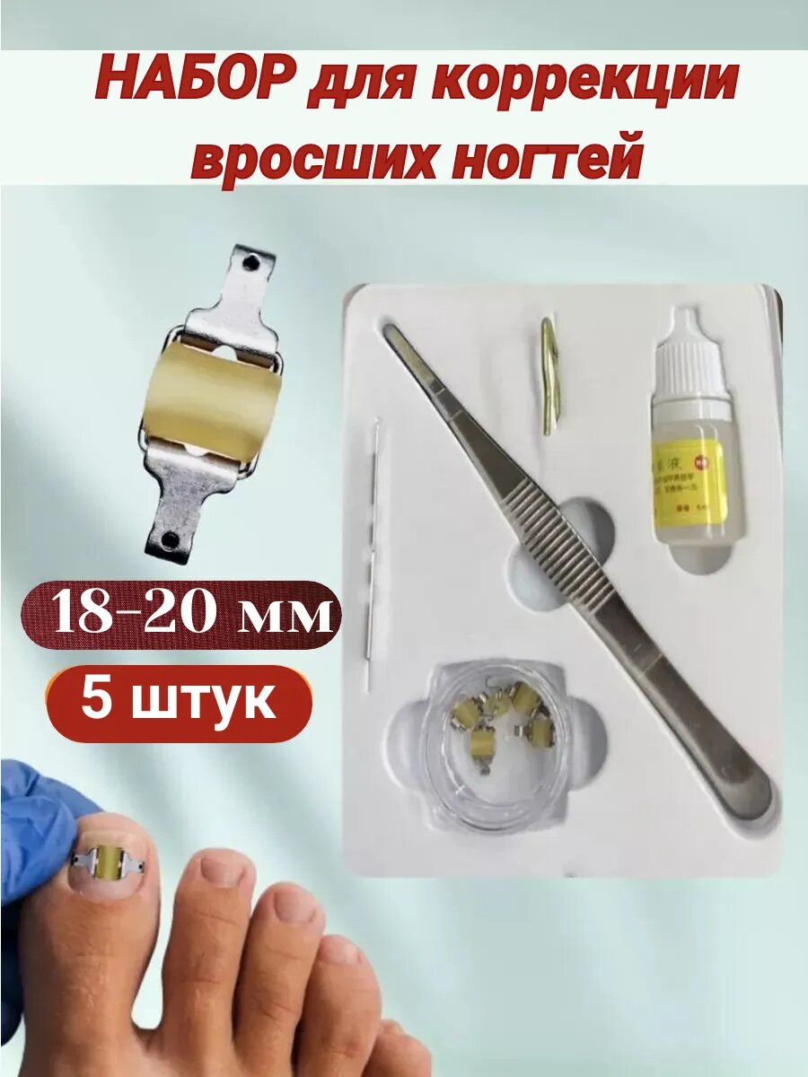 Набор для коррекции вросшего ногтя, 18-20 мм