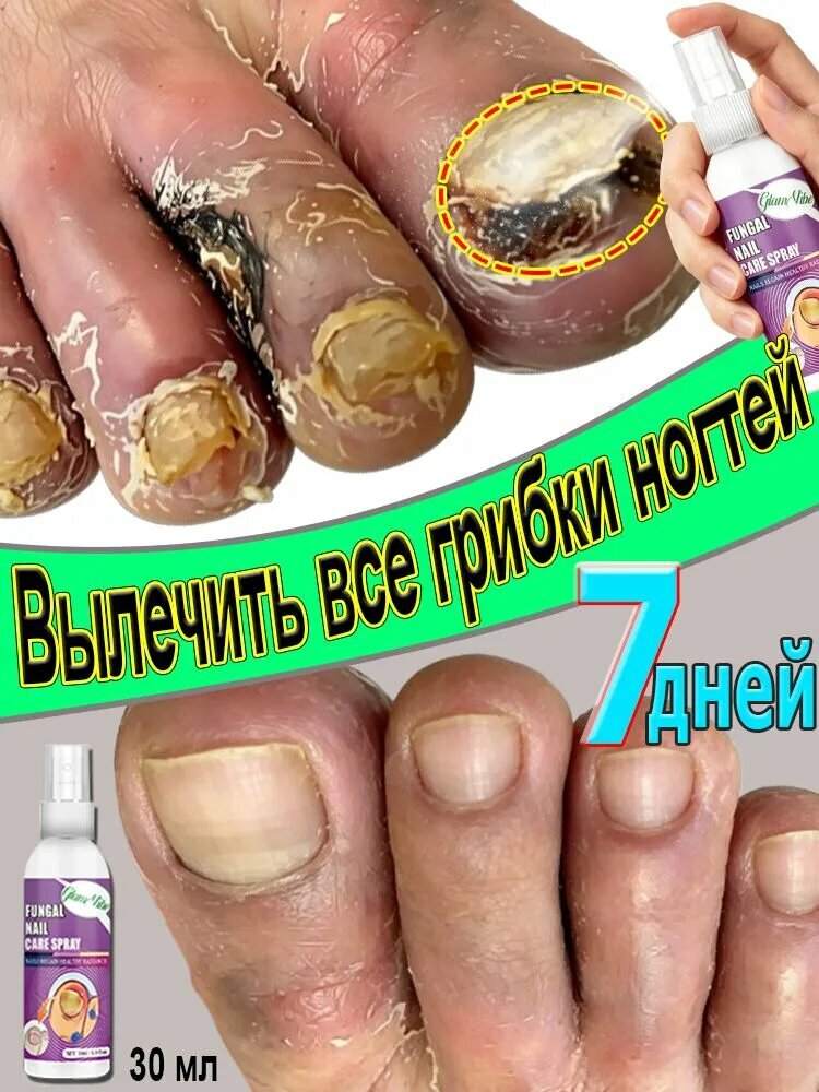 Спрей для лечения грибковых поражений ногтей на ногах, предотвращающий расслаивание, пожелтение и утолщение ногтей, восстанавливающий поврежденную кожу и околоплодник, а также устраняющий зуд.90 мл