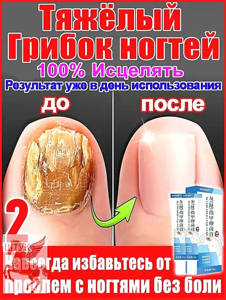 2 штуки, крем ноготок от грибка ногтей на ногах, ноготок мазь от грибка на ногах, гиперкератоз