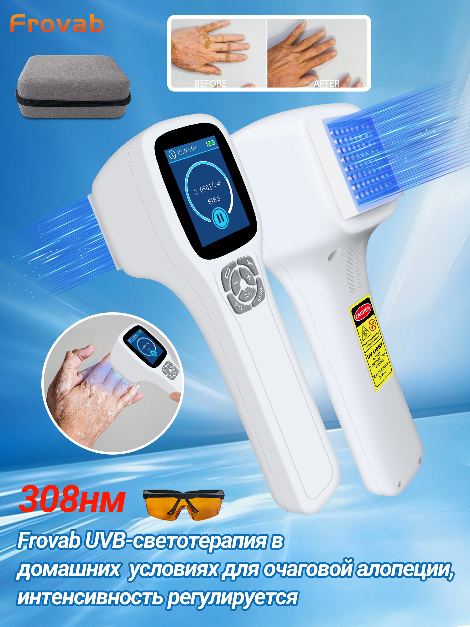 Портативный УФ облучатель Frovab 308нм 49 диода, использование дома, терапия кожных болезней взрослых разных стадий