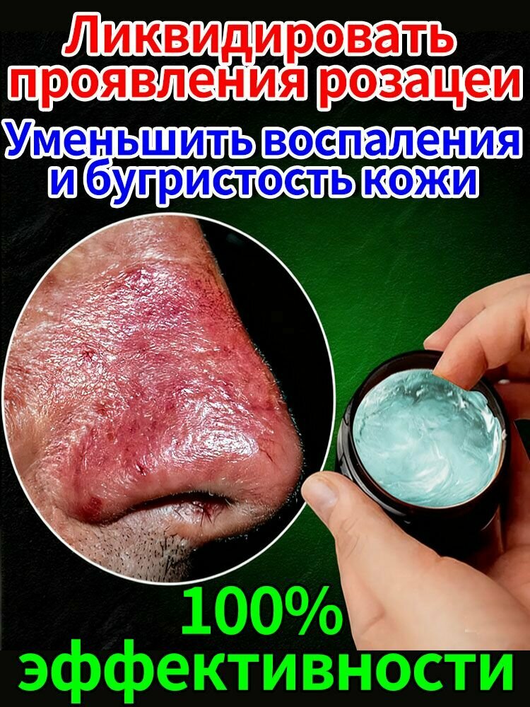 Мазь от Китайский розацеа на лице купероза и покраснений