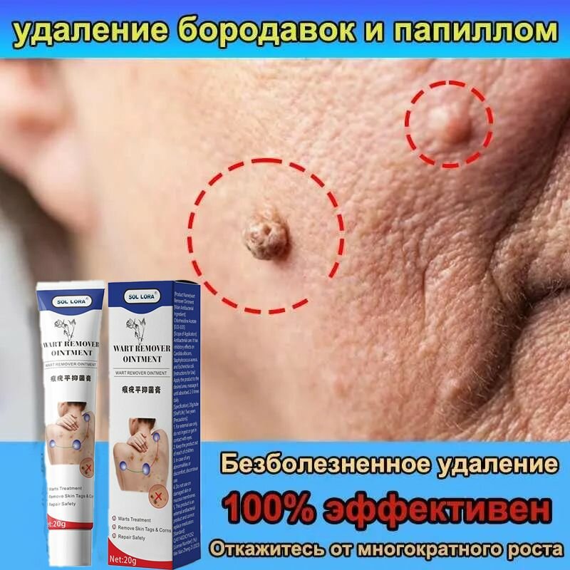 Крем от папиллом и бородавок, Подходит для лечения обычных бородавок, нитевидных бородавок, мозолей, натоптышей и чистотела 20 грамм