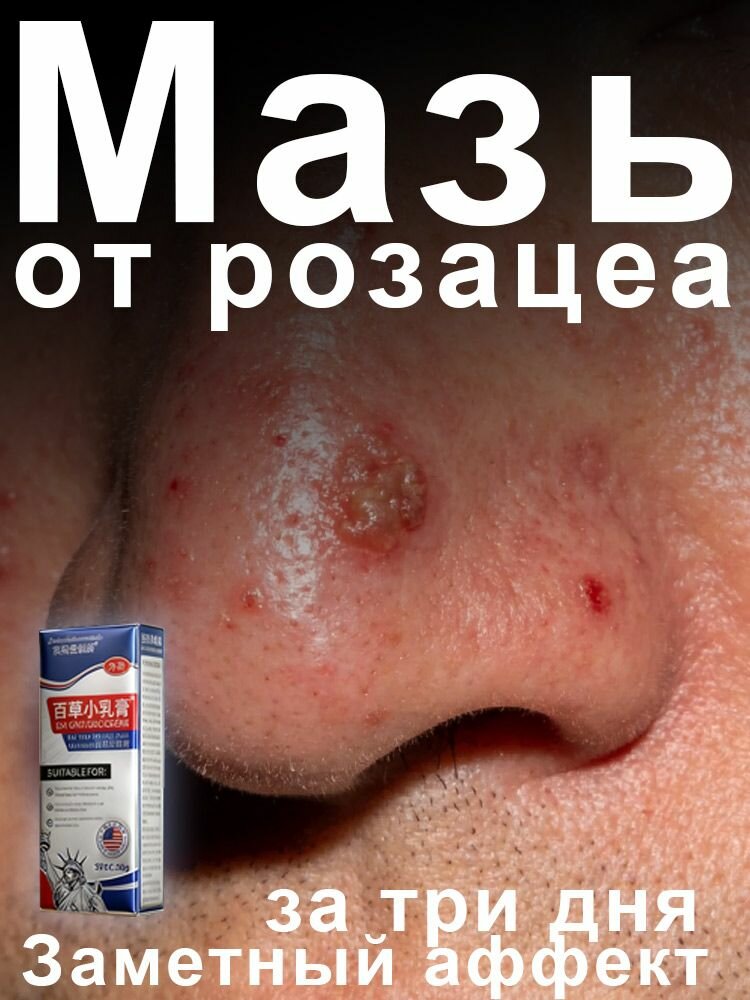 Мазь от розацеа на лице купероза и покраснений, Средство от розацеа, Китайская чудо-мазь для лечения розацеа,20 мл