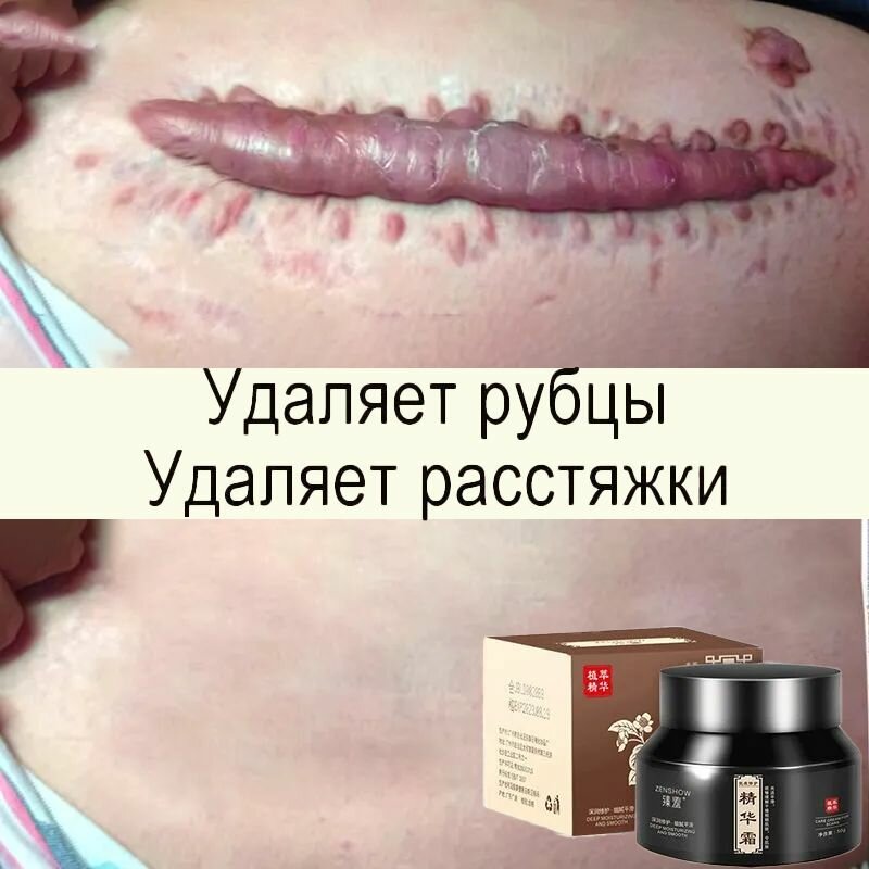 Крем для удаления шрамов. от растяжек от постакне от шрамов и рубцов от ожогов, для лица и тела, Натуральные и безопасные ингредиенты 50 г