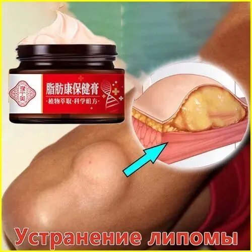 Мазь от липом и жировиков, быстро удаляет подкожные жировые опухоли, натуральный китайский, травяной крем для удаления целлюлита устранения, 30 г