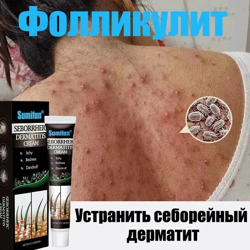 Мазь для тела для лица, ног, рук от дерматита, псориаза, экземы, прыщей, зуда, 20 г