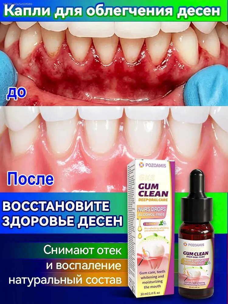Капли для десен, для обезболивания и снятия отека, при зубной боли, воспалении десен, прорезывании зубов мудрости и кариесе. Снижает чувствительность, укрепляет десны. 30 мл