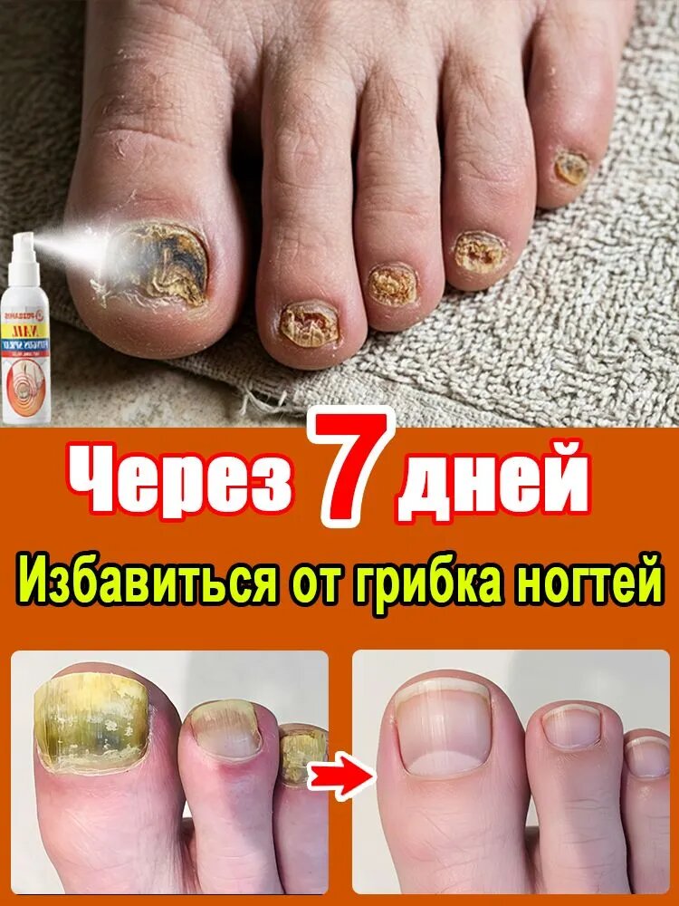 Противогрибковая сыворотка для ногтей лечение онихомикоза и паронихии восстановление здоровья ногтей быстрый эффект натуральный состав.30 мл