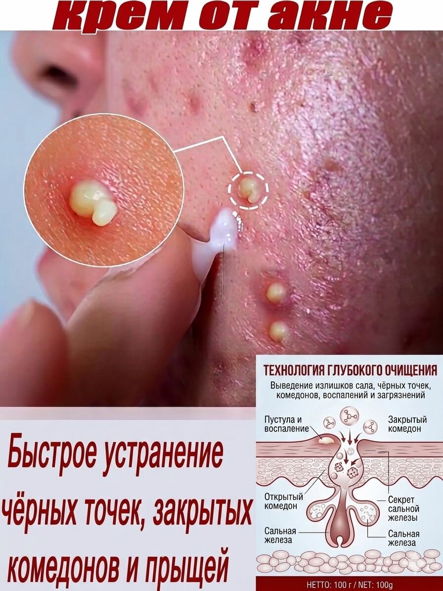 Крем от прыщей точечный, от акне комедонов угрей черных точек, средство для подростков, для проблемной кожи, гель от прыщей на лице cалициловая