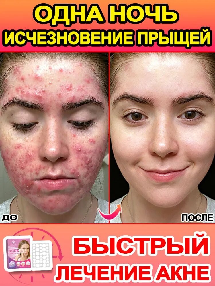 Пластыри от акне/72 шт. в упаковке. Используются для лечения акне и прыщей на лице. Быстро снимают воспаление. Подходит для чувствительной кожи.