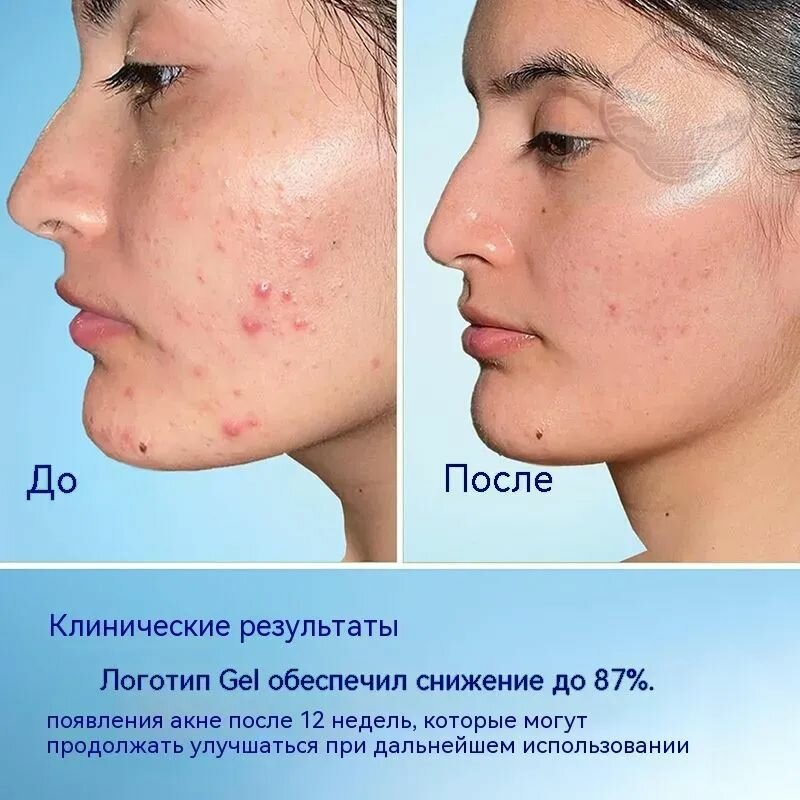 Differin, 0,1% Adapalen гель для ухода за кожей, для облегчения прыщей (лицевой витаминной кислоты), 15 г, Differin гель