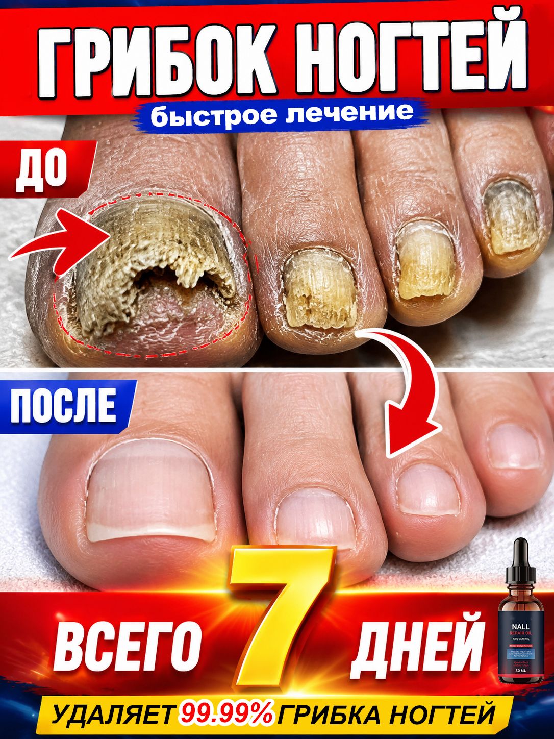 Масло используется для лечения грибка ногтей. Противогрибковая сыворотка. Эффективное средство для лечения грибковой инфекции ногтей на ногах, 30 мл/флакон