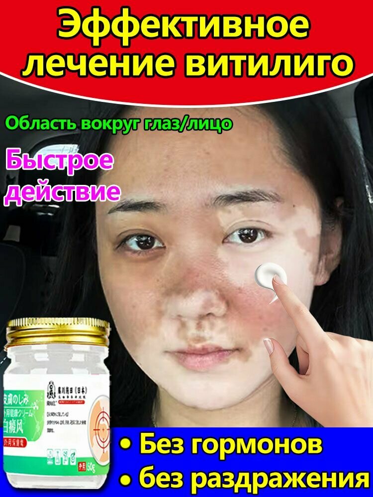 Мазь, используемая для лечения витилиго. Эффективно удаляет белые пятна, заживляет кожу, пораженную витилиго, и избавляет от странного взгляда окружающих.50 грамм