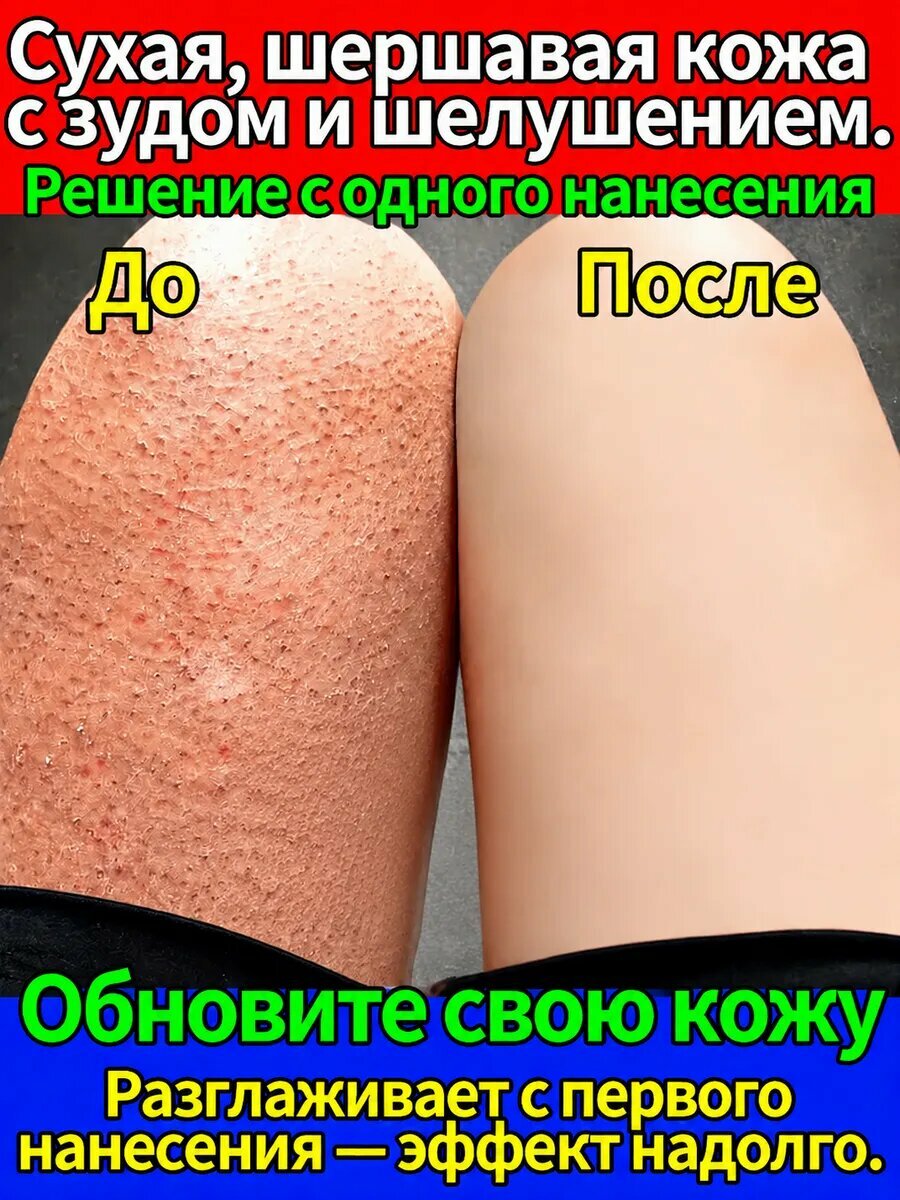 Крем для тела против гиперкератоза