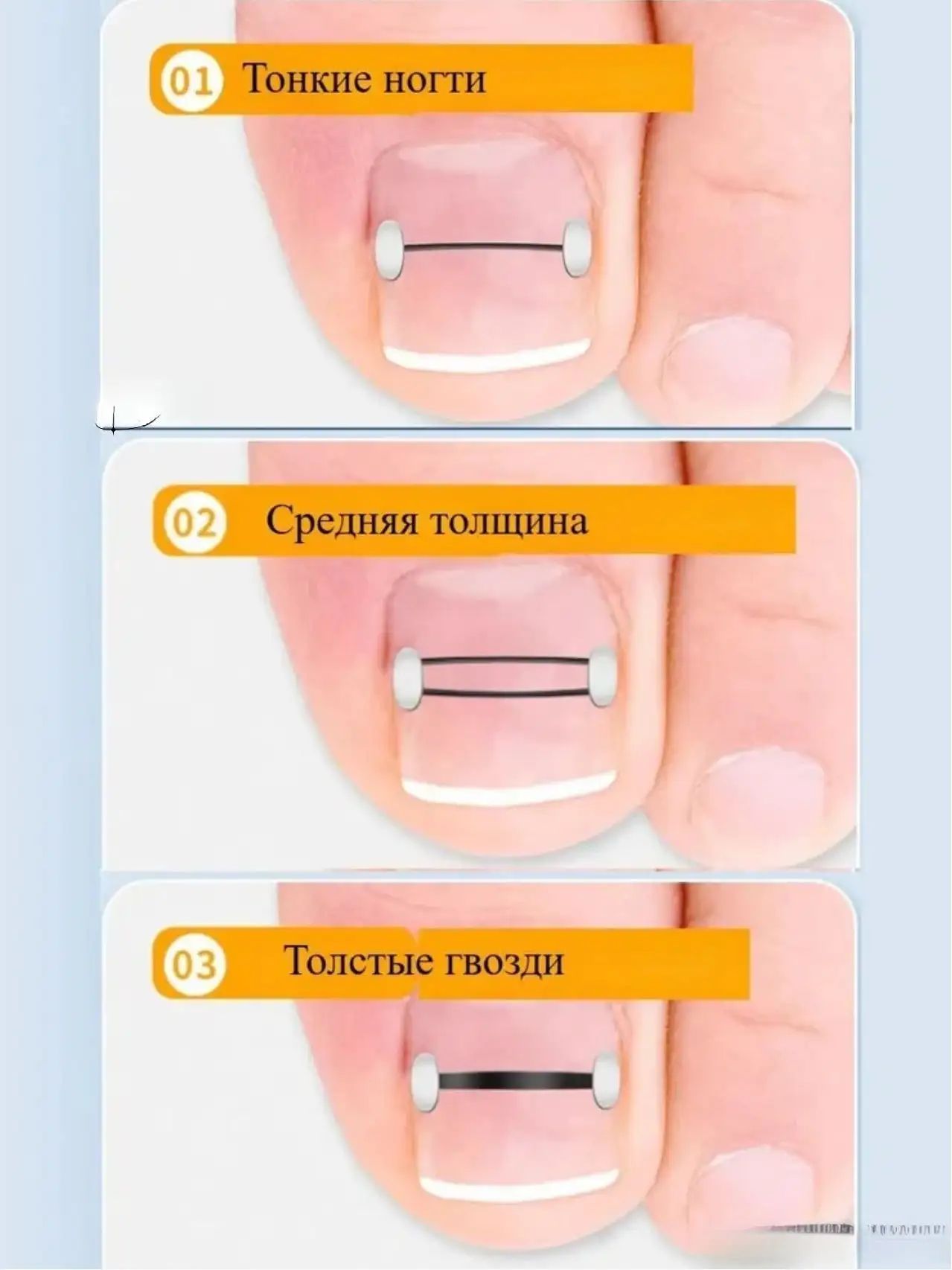 Набор инструментов для коррекции вросшего ногтя (набор из 10+5 предметов для лечения вросших ногтей)