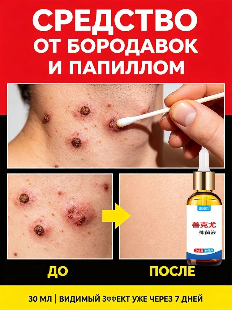 Препарат для выведения бородавок, папиллом, шипиц Натуральный состав