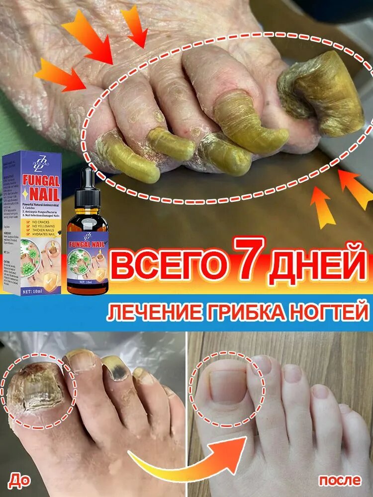 Сыворотка от грибка ногтей, Эффективное средство для лечения утолщенных и желтых ногтей в домашних условиях
