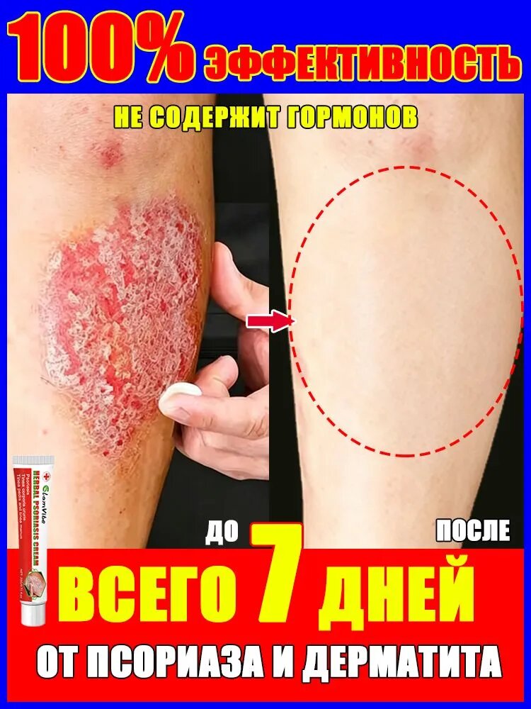Крем от псориаза для лечения псориаза, дерматита и экземы. Восстанавливает кожный барьер, Снимает зуд и раздражение кожи, вызванные аллергией. 100 г
