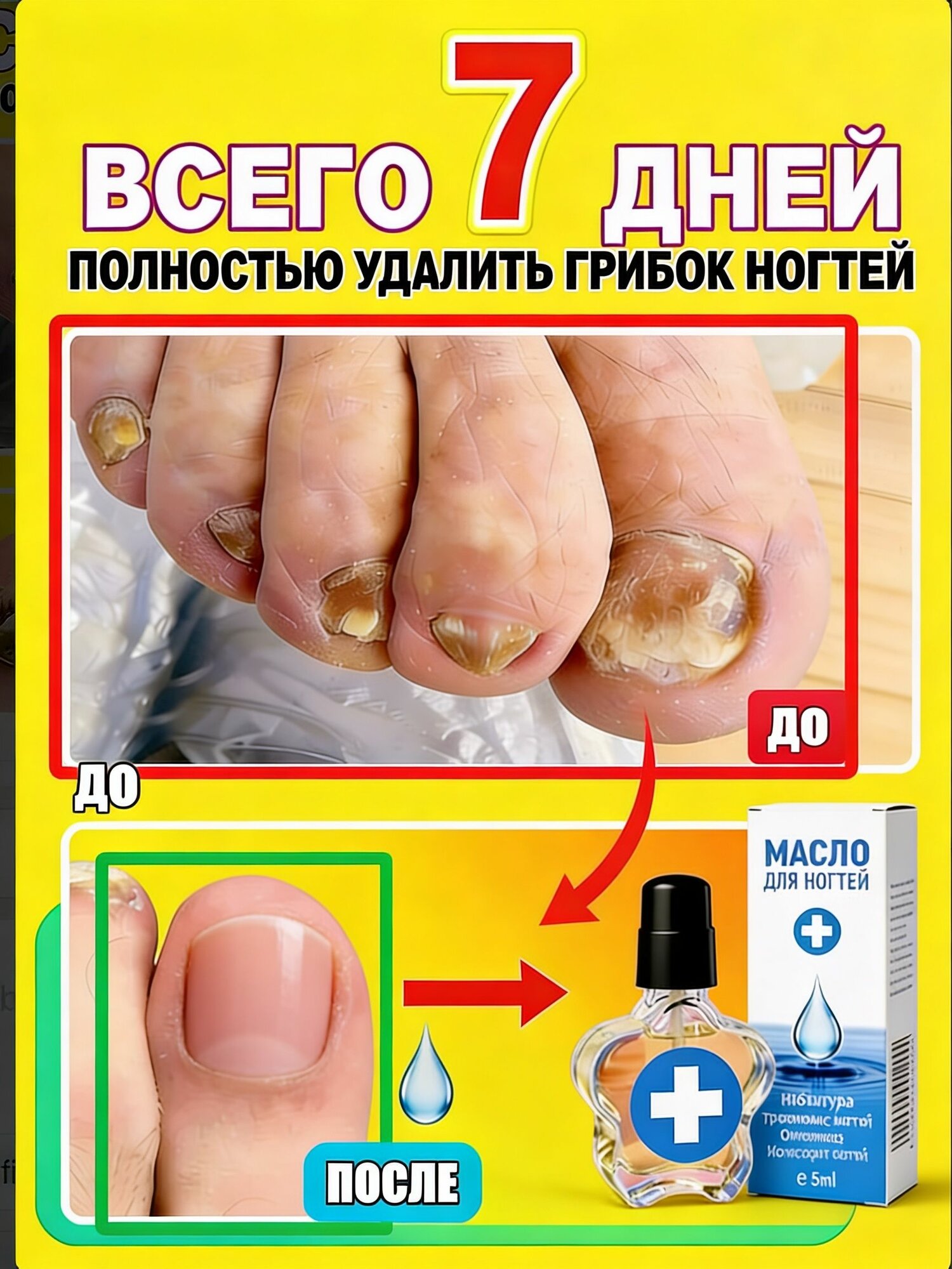 Эффективное средство от грибка ногтей на ногах, стоп онихолизис, масло для ногтей и кутикулы,5 мл