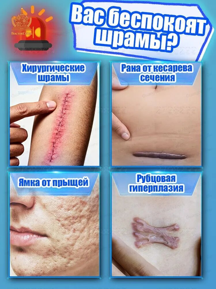 Лазерный аппарат для удаления рубцов. Быстро удаляет гипертрофические , послеоперационные рубцы и после родов, осветляет пигментацию рубцов и делает кожу гладкой. одна лазерная ручка