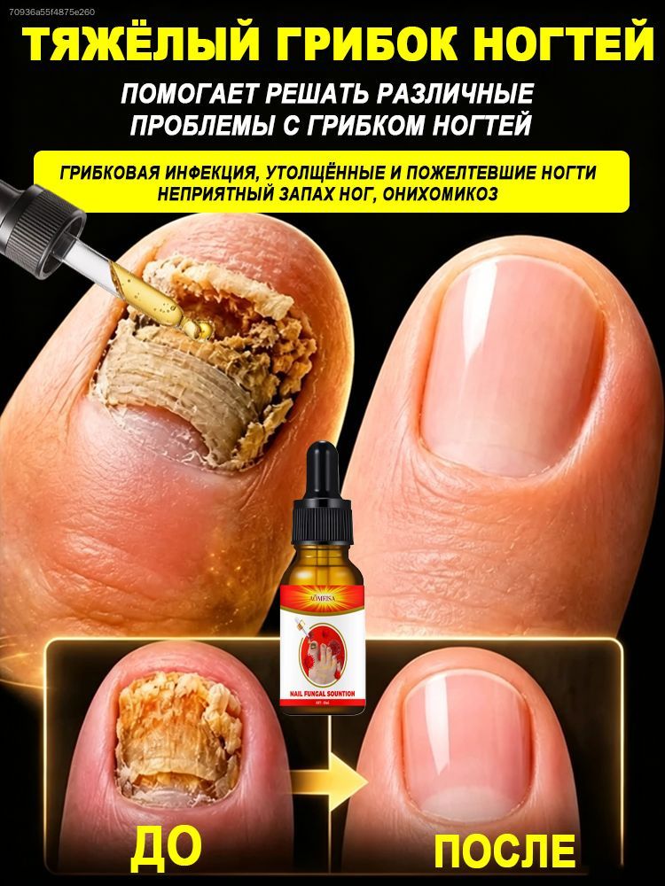 Средство от грибка ногтей на руках и ногах/ Масло от онихомикоза. Противогрибковое , Устранение паронихии восстанавливает ногти. Попрощайтесь с онихомикозом!10 мл