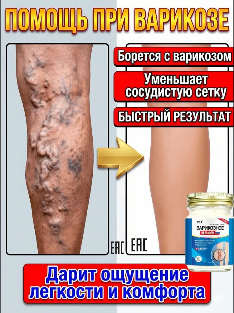 Китайская Чудо мазь от Варикоза и усталости , Мазь от варикоза вен на ногах , Средство от отеков и тяжести в ногах, от венозных сеточек при тромбофлебите