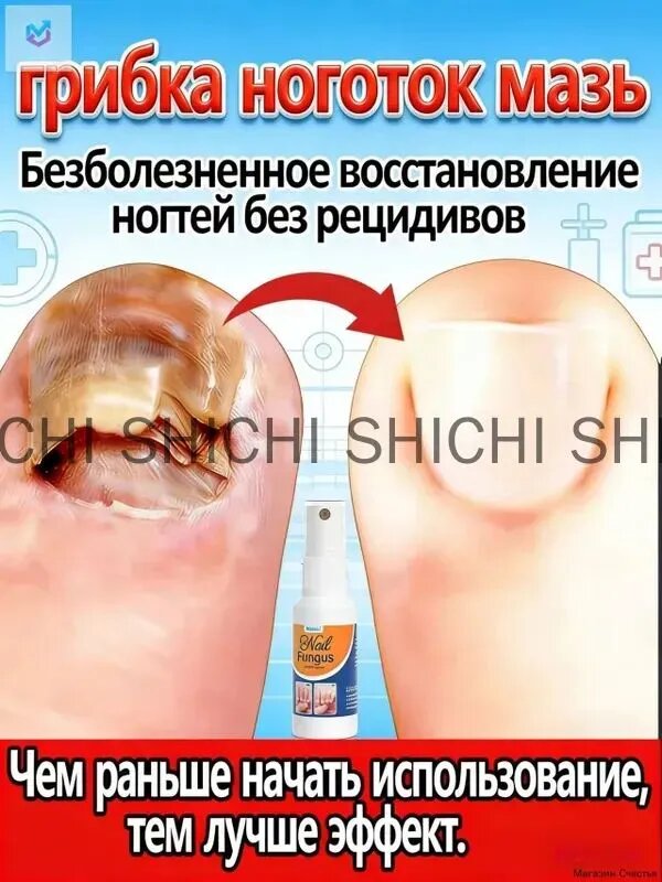 Противогрибковый спрей, от грибка ногтей на ногах, от трещин, для пяток и стоп, мазь от псориаза, зуда, микозе, спрей для ног