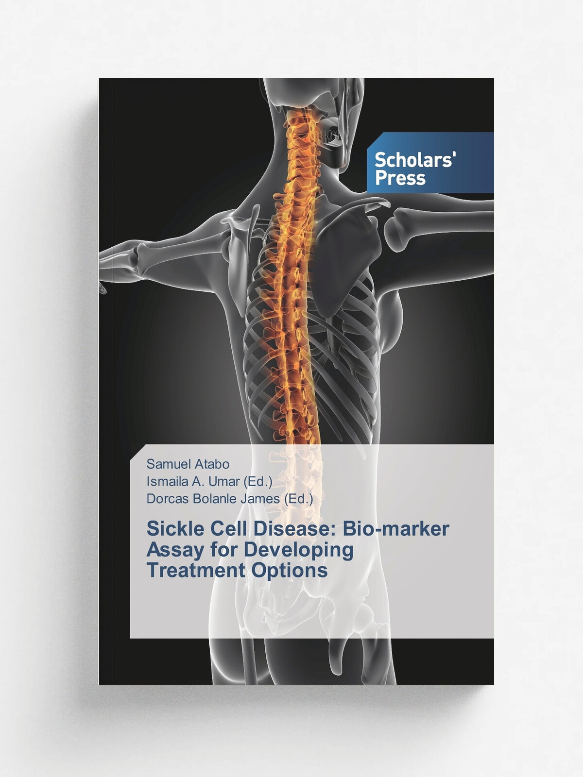 Sickle Cell Disease. Bio-marker Assay for Developing Treatment Options