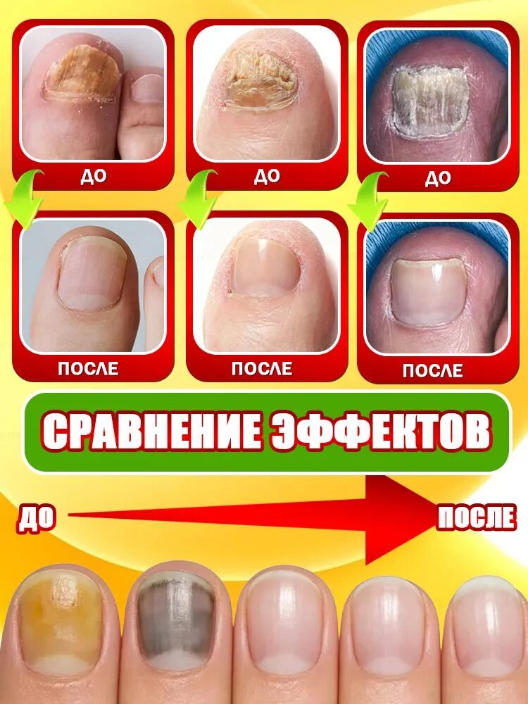 Крем от онихомикоза: обладает антибактериальными и противогрибковыми свойствами, глубоко восстанавливает поврежденные ногти, увлажняет кончики ногтей и способствует быстрому росту ногтей.