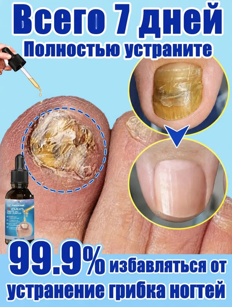 Средство от грибка ногтей, лечение онихомикоза, восстановление ногтей