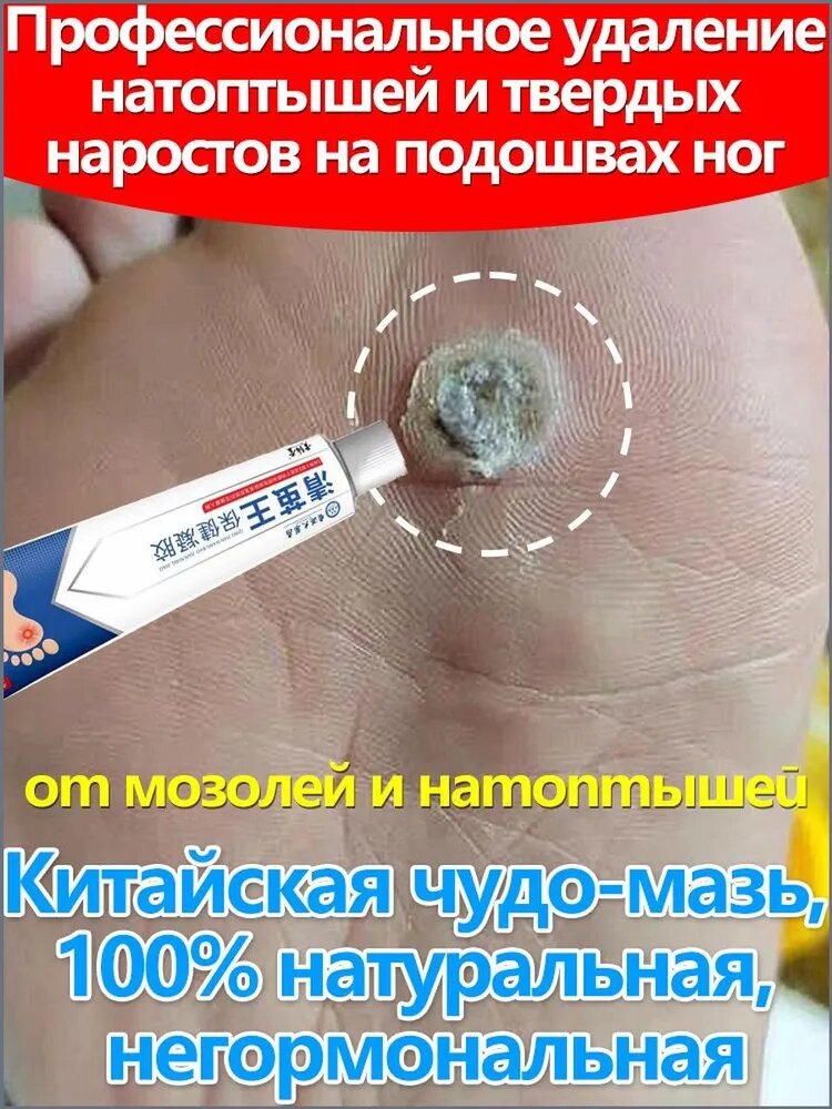 Мозоли на пальцах ног, натоптыши, боль при ходьбе/вальгусная деформация стельки, шишки,20 г