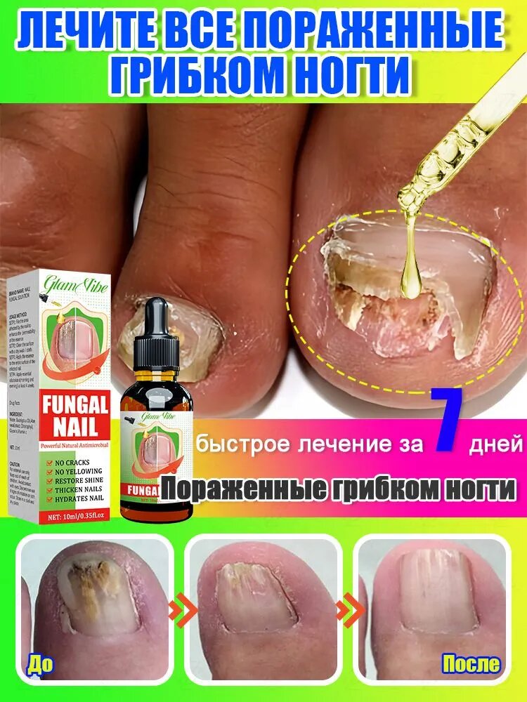 Используется для лечения грибка ногтей на руках и ногах. Лечение онихомикоза, укрепляйте и восстанавливайте ногти и роговой слой кожи, а также устраняйте грибок ногтей на ногах.10ml.