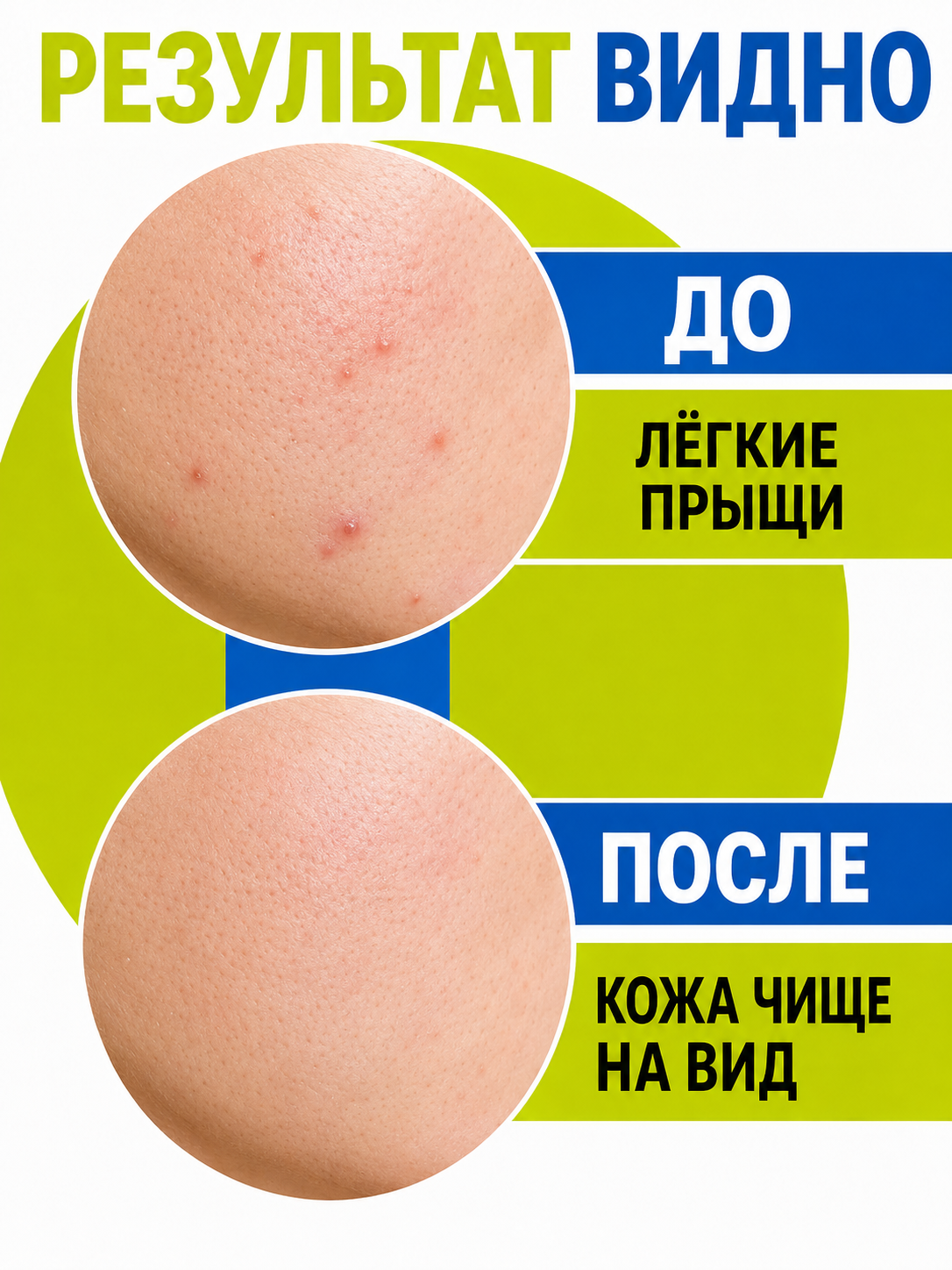 Гель Elegant Cosmed 2.5%, против акне, 30мл, без парабенов, некомедогенный — фото 1