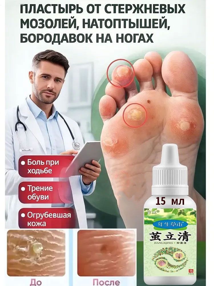 От шипиц, подошвенных и ладонно-подошвенных бородавок, натоптышей и мозолей на ногах - эффективное удаление и лечение для женщин и мужчин. ин
