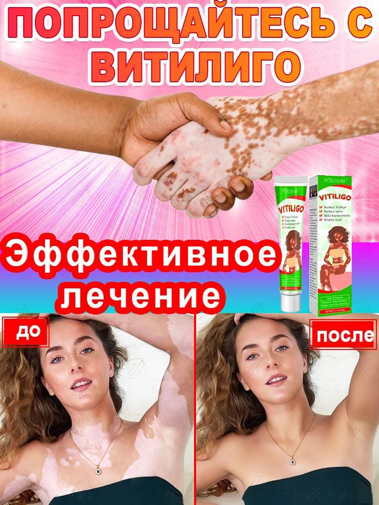 Этот препарат используется для лечения гиперпигментации. Он также может применяться для лечения витилиго, удаления пигментации и выравнивания тона кожи.20 г