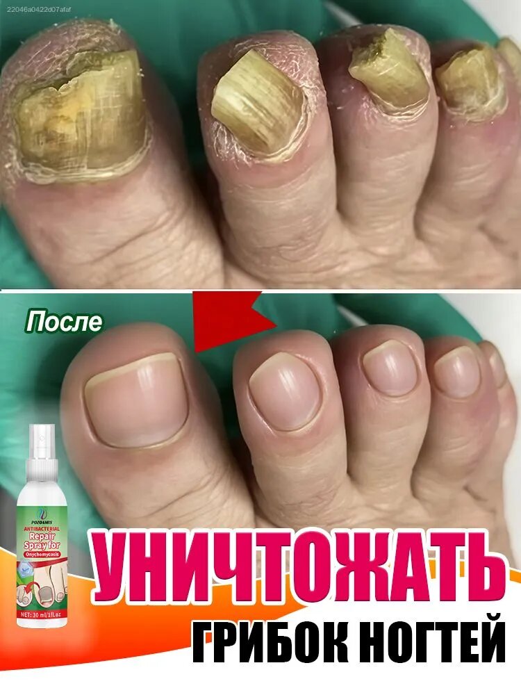 Спрей от онихомикоза масло от грибка ногтей на ногах. Средство от грибка ногтей на ногах