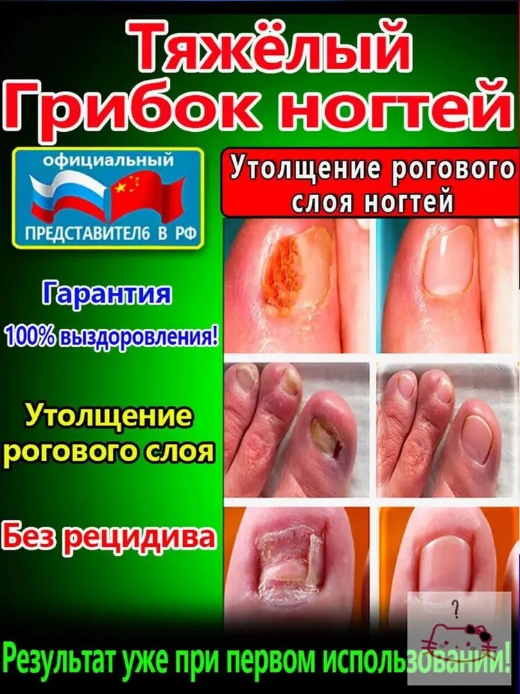 Противогрибковая мазь Ноготок от грибка ногтей на ногах и гиперкератоза, противогрибковое средство для ног, укрепляйте и восстанавливайте ногти