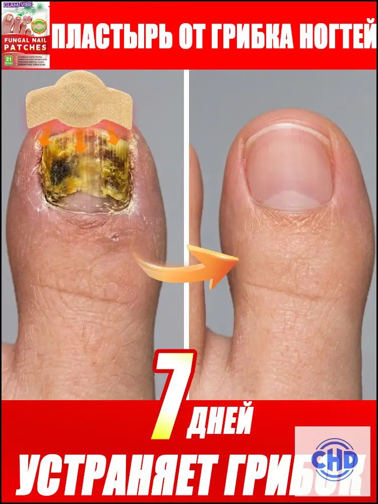 Лечебный пластырь против онихомикоза, купирующий зуд и болевой синдром при паронихии, применяемый для интенсивного