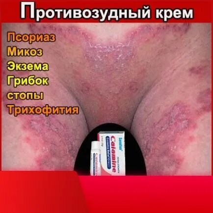 Эксклюзивный крем 20 г для лечения псориаза, экземы, герпеса, акне, а также ожогов, порезов, прыщей на лице и укусов насекомых.
