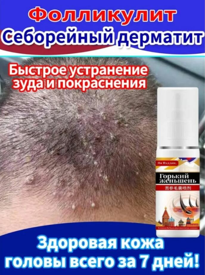 Лечение фолликулита, прыщей и акне на волосстой части головы, Враг перхоти, 20 г.