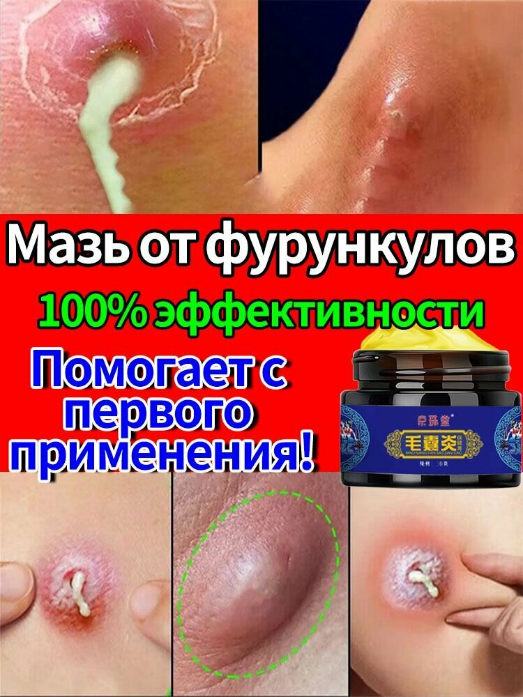 Лечебная мазь от фурункулов, акне, гнойников и абсцессов, устраняет гнойную инфекцию, снимает воспаление, предотвращает образование рубцов 30г