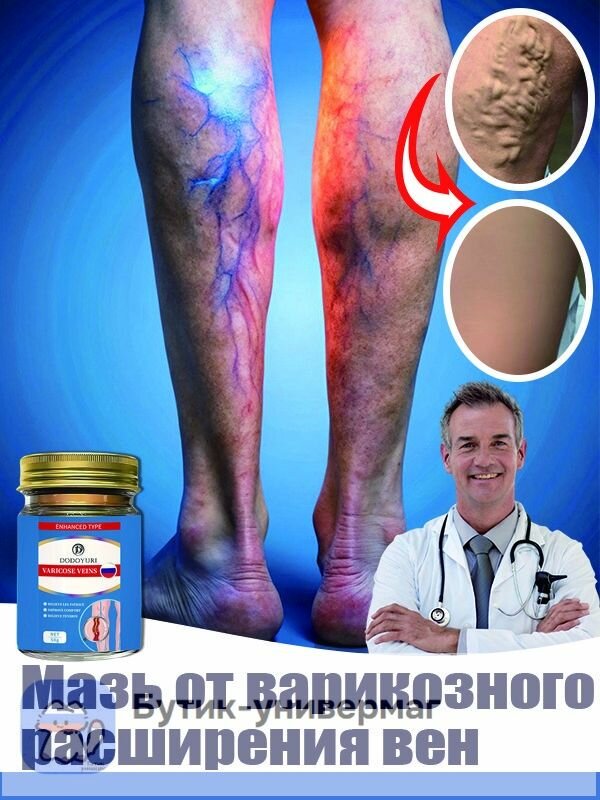 Мазь для лечения варикозного расширения вен ног, подходит для лечения отеков и тяжести в ногах, сосудистой се сосудистой сетки