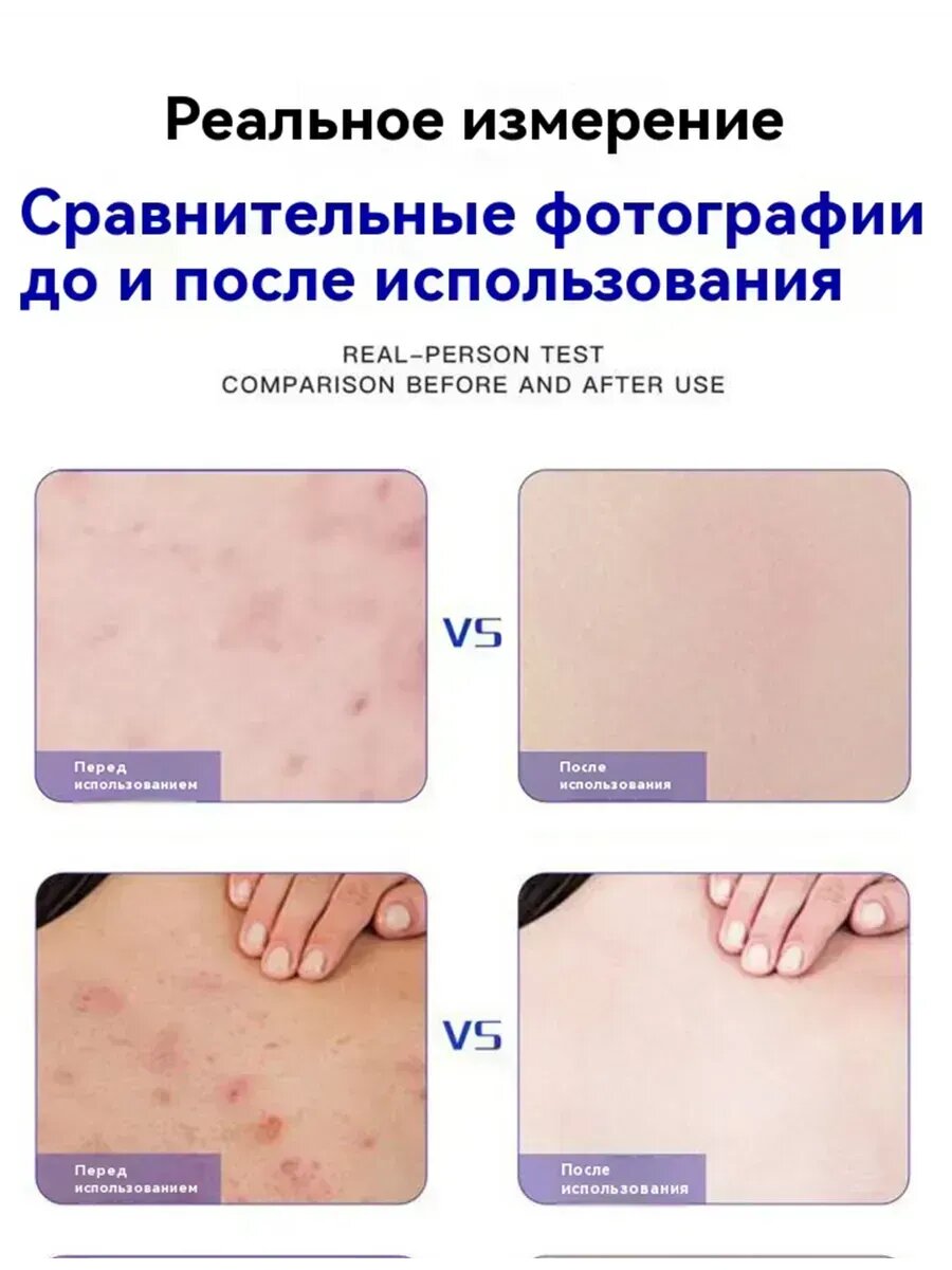 Мыло от прыщей, акне для лица и тела，Эффективность 100%