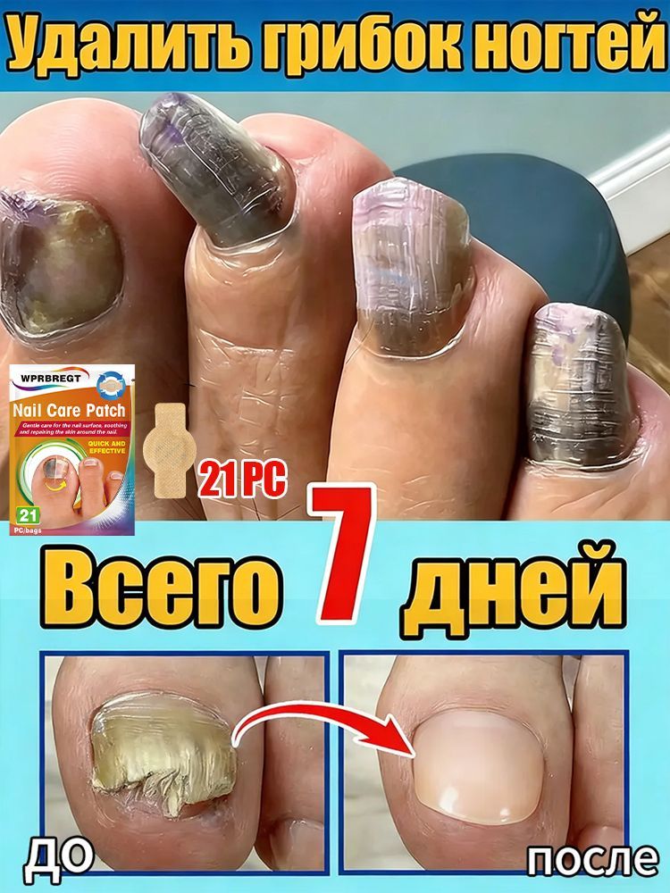 Наклейки для ногтей проникают глубоко в ткани, уничтожают грибковые инфекции, восстанавливают утолщенные, пожелтевшие и поврежденные ногти, 1 упаковка