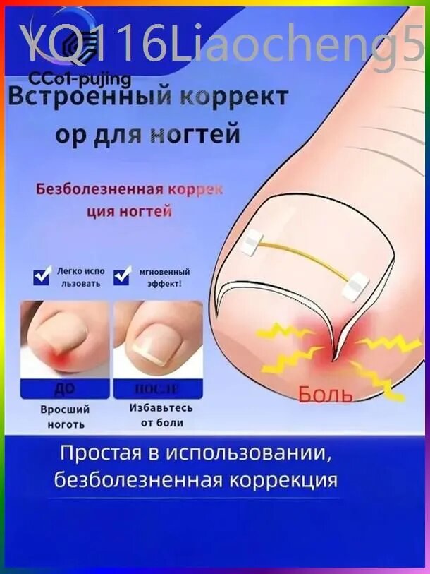 Комплект из 10 никелид-титановых корректоров для вросших ногтей