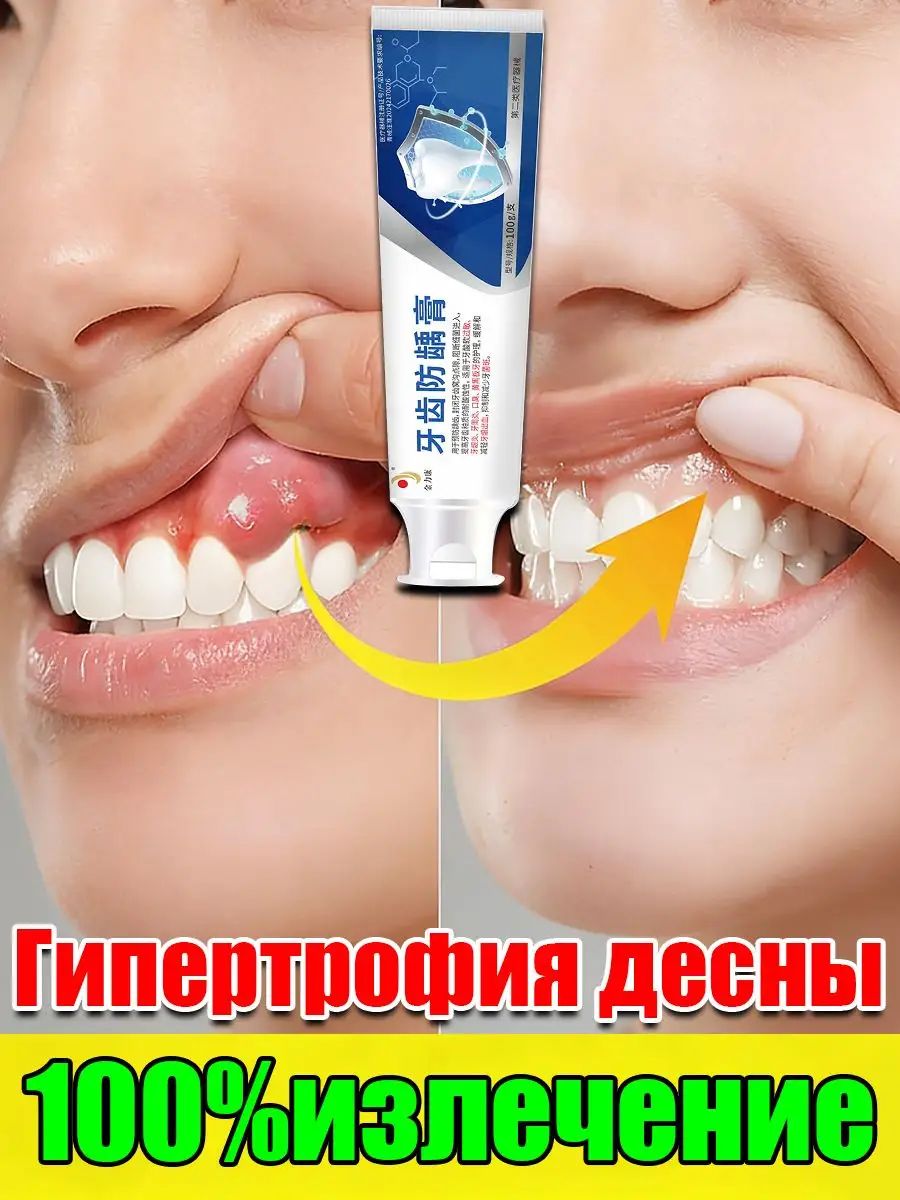 Паста от флюса и воспаления десен