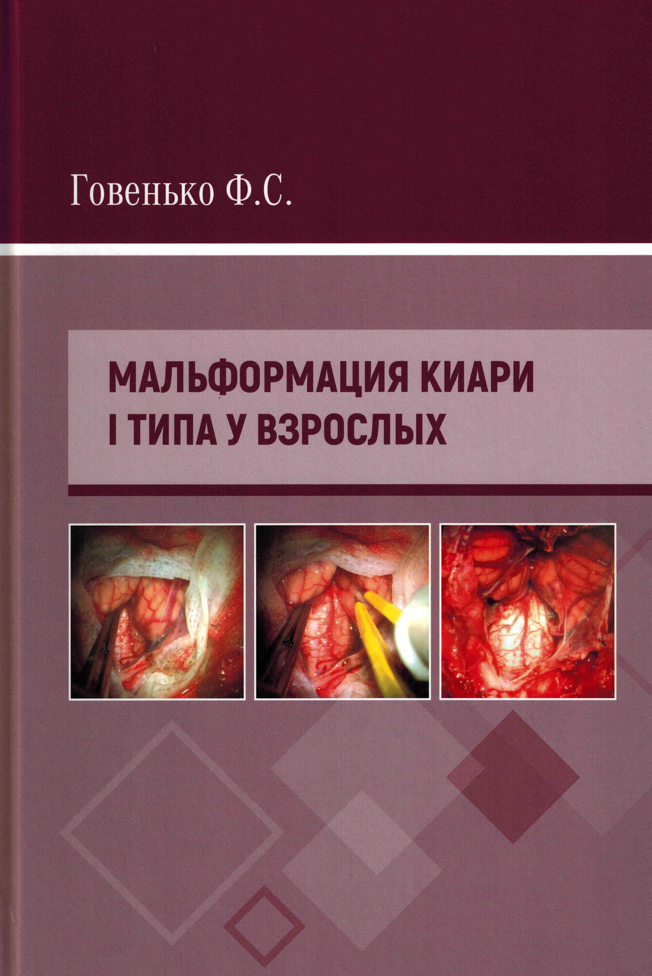 Мальформация Киари I типа у взрослых